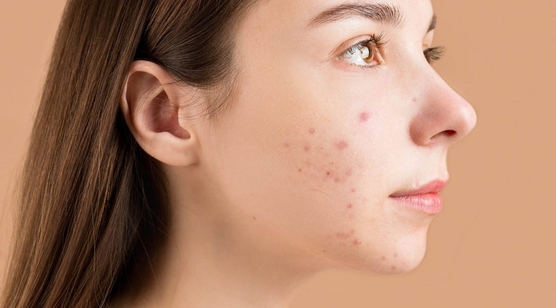 What is Post Inflammatory Erythema (PIE), and How You Can Treat It Eff ...